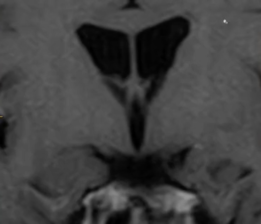 Koedam Parietal Atrophy Scale - MRI Online is now Medality