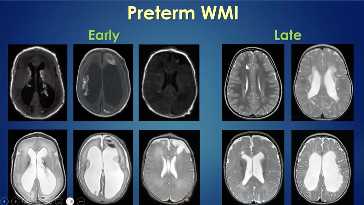 Preterm Brain Imaging - Medality / MRI Online