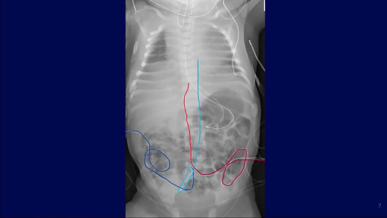 Introduction to Neonatal Lung Disorders - MRI Online is now Medality