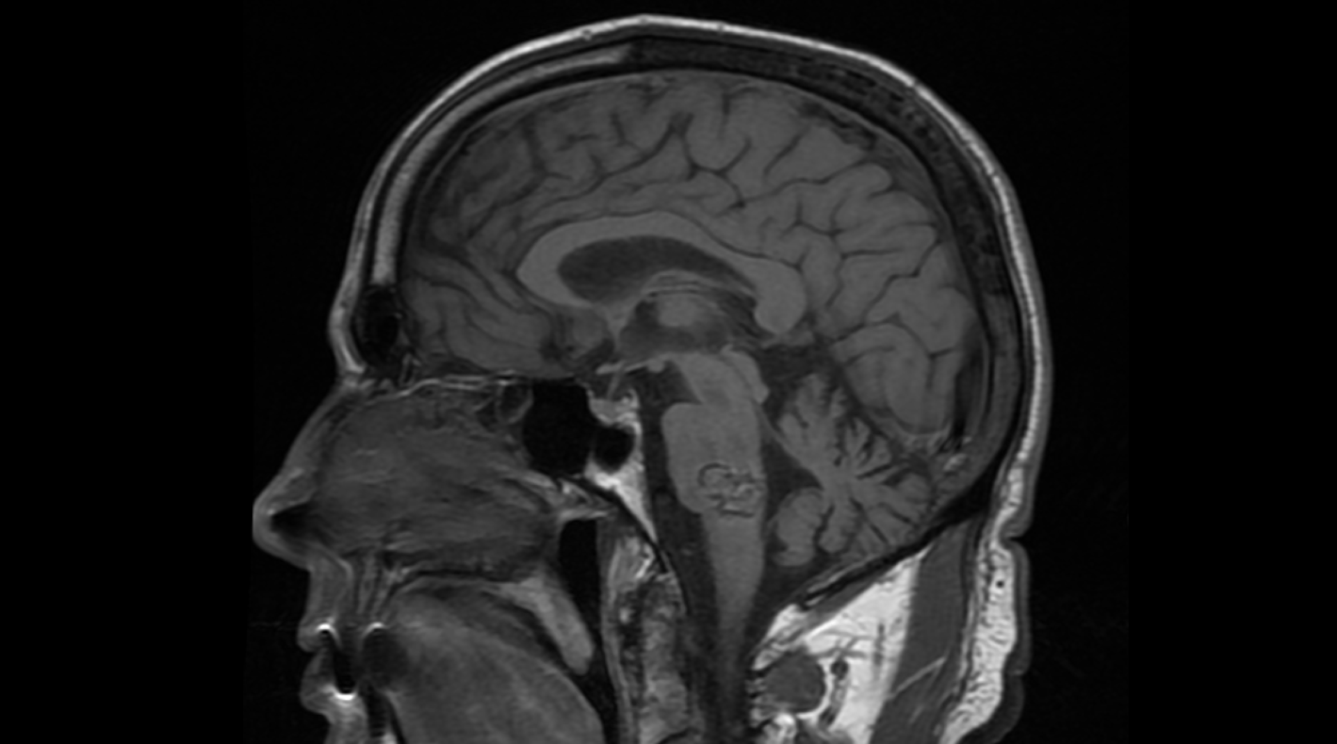 Toronto Neuro Diagnostic Case Review - Radiology Course - Medality ...
