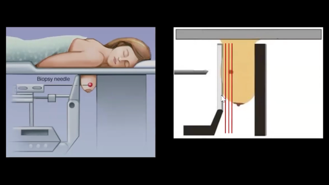 Stereotactic Technique - MRI Online is now Medality