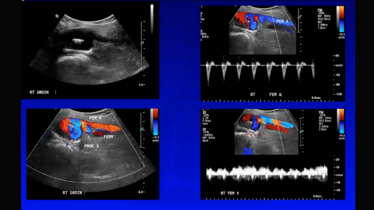 Case: Arterio-Venous Fistula - MRI Online is now Medality